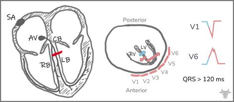 Left Bundle Branch Block Ecg Stampede