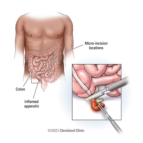 Laparoscopic Appendectomy Incision Sites