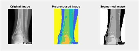 Figure 1 From Feature Extraction And Classification Of Bone Tumor Using Cnn Classifier With Knn