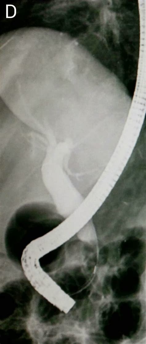 Ercp And Egd Diverticula Galore