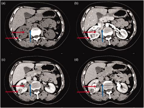 Non Contrast Enhanced Computed Tomography A And Contrast Enhanced
