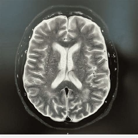 Mri Of Head Showing Dural Enhancement Mri Magnetic Resonance Imaging Download Scientific Diagram