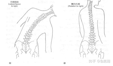 【脊柱侧弯】脊柱力学中 人体力学功能失常 知乎