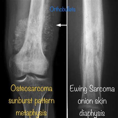 Fibrosarcoma X Ray