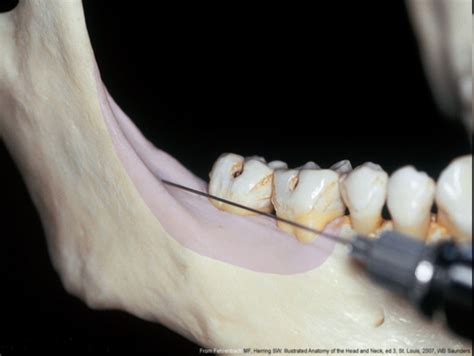 Buccal Injection Flashcards Quizlet
