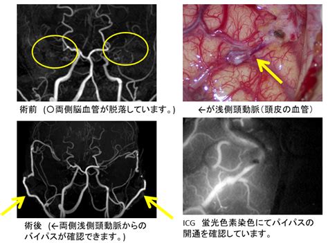 治療内容の紹介直達手術脳神経外科診療科センター新小文字病院