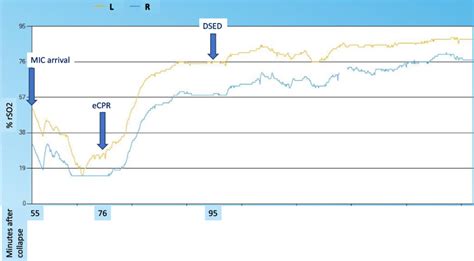 Out Of Hospital Cardiac Arrest Treated With Prehospital Double Sequential External