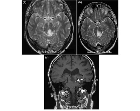 Comparative Axial T2 Images Demonstrating Growth Of The Midbrain Mass