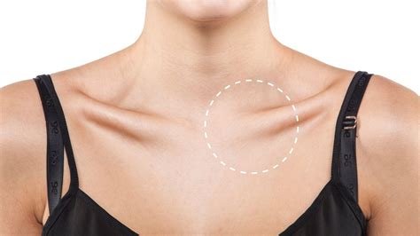 Clavicle Fracture Physiotherapy Rehab Protocol Simplified To Get Back