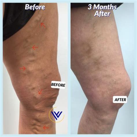 Before And After Wilton Ct And Fairfield Ct Center For Varicose Veins