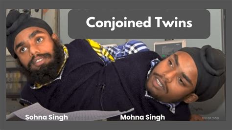 Indian Conjoined Twins Sohna Singh And Mohna Singh Inspirational