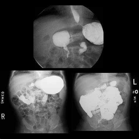 Malrotation With Midgut Volvulus Pediatric Radiology Reference