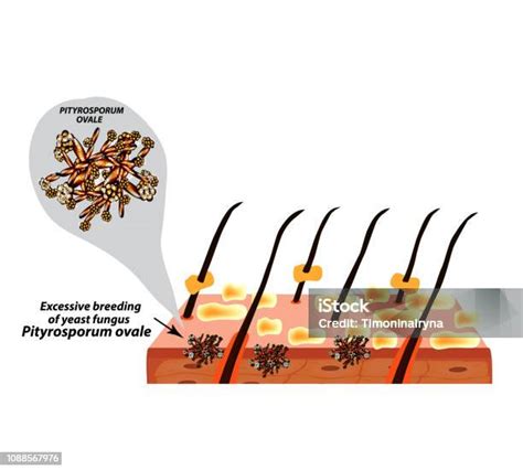 Jamur Ragi Patogen Seborrhea Pityrosporum Ovale Malassezia Furfur Kulit