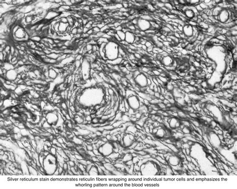 Pathology Outlines Endometrial Stromal Nodule