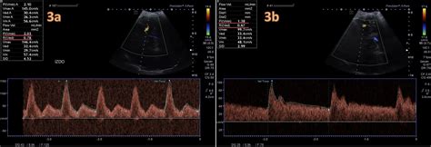 Fundoscopy Or Point Of Care Ocular Ultrasound Anales De Pediatría