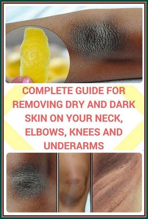 Complete Guide For Removing Dry And Dark Skin On Your Neck Elbows