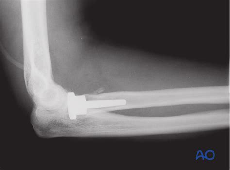 Radial Head Arthroplasty For Radius Complete Articular