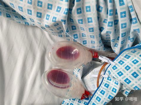男性乳腺发育手术 知乎