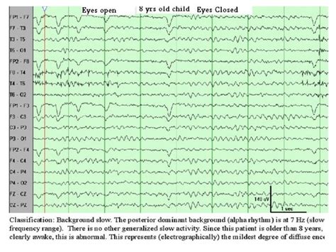 Normal Awake And Sleep Eeg Ppt