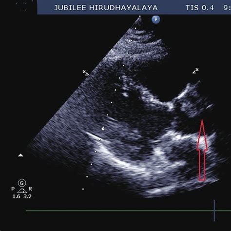 Parasternal Long Axis View On 2d Echo Showing Thrombus Red Arrow At Download Scientific