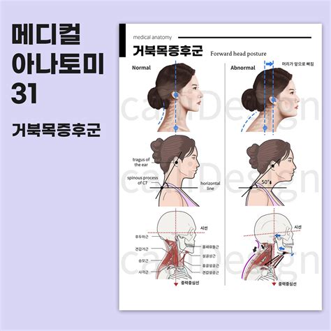 의학그림 메디컬 일러스트 Callidesign 나쁜체형 좋은체형 비교 포스터 디자인입니다 참고용 교육용으로 사용하실 수