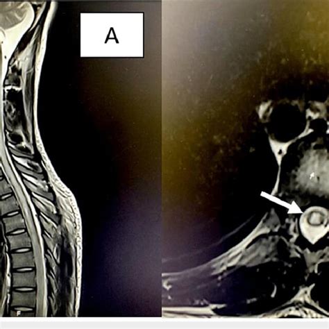 Mri Of The Spine Cervical And Thoracic Sagittal A And Axial B