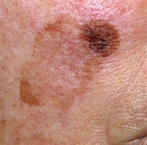 Lentigo Melanoma Icd 10 С43 Online Consultation Ai Dermatologist