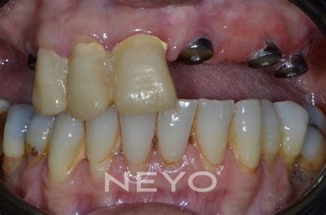 Dental Implants Neyo Dental West Sussex Dental Clinic