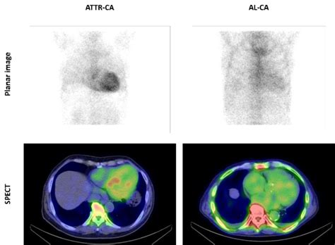 Cardiac Uptake Of 99m Tc Pyp In Patients With Cardiac Amyloidosis The