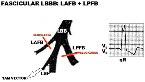 Atypical Lbbb With Initial Q Waves In Left Precordial Leads Download