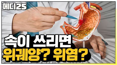 위궤양 이번 영상으로 위염과 위궤양을 구별해두세요 Youtube