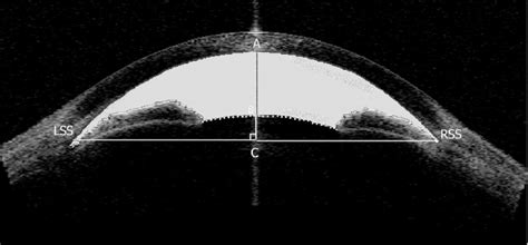 Schematic Figure Illustrating Anterior Segment Biometric Parameters Download Scientific Diagram