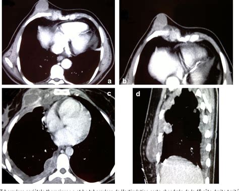 Figure 1 From [surgery For Thoracic Tuberculosis] Semantic Scholar