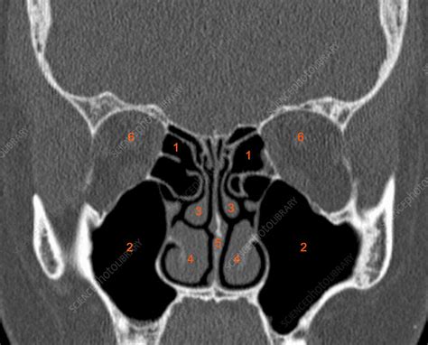 Normal Sinuses Ct Scan Stock Image C0294639 Science Photo Library