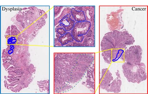 Figure 1 From Rmdl Recalibrated Multi Instance Deep Learning For Whole Slide Gastric Image