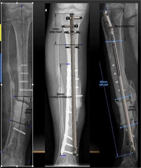 Preoperative Implant Planning 63 Mm Tibial Defect Selection Of 300 Mm
