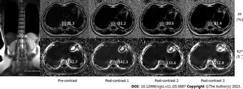 Hepatic Mr Imaging Using Ideal Iq Sequence Will Gd Eob Dtpa Interfere