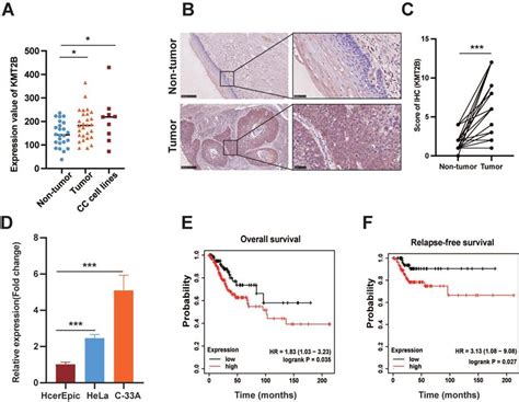 Histone Methyltransferase KMT2B Promotes Metastasis And Angiogenesis Of