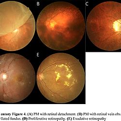 Image 4 AI Model For Identifying Pathologic Myopia Based On Deep