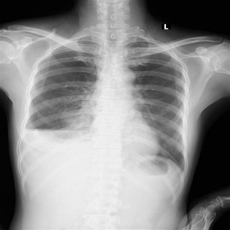 Deteksi Object Detection Dataset By Detection