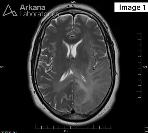Diffuse Astrocytoma Idh Mutant Grade 2 Tiktoktoktok