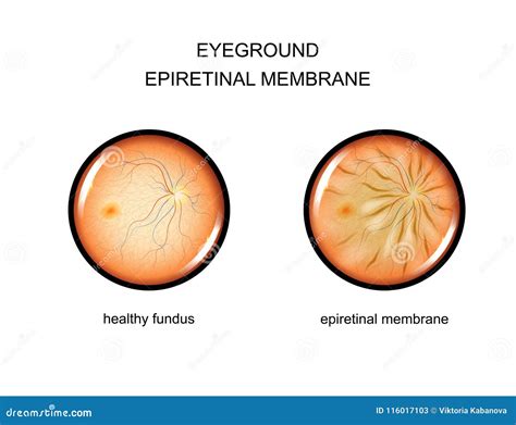 Fundus Epiretinal Membrane Cartoon Vector 116017103