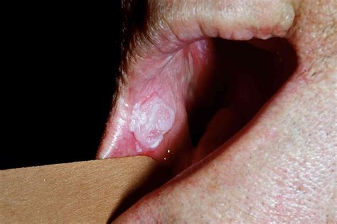 Throat Cancer Look Like