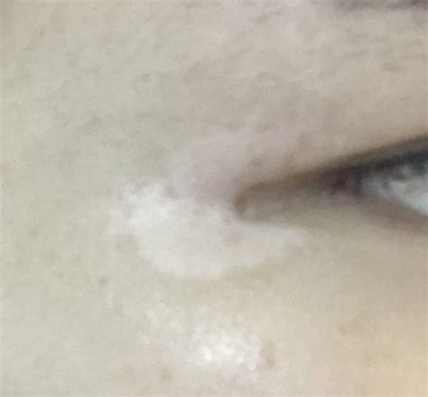 백반증 백반증 치료과정 솔직후기회복 네이버 블로그