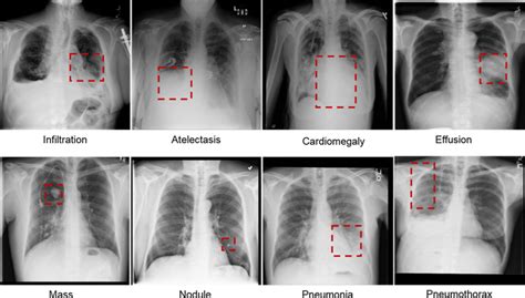 Pneumothorax Vs Atelectasis