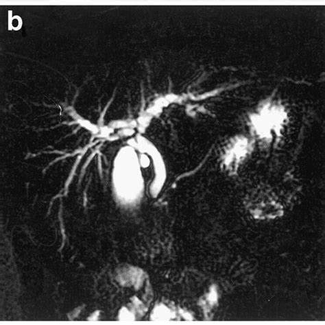 mr cholangiogram from patient b at 7 years of age before download scientific diagram