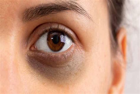 3 Tips For Under Eyes Circle आंखों के नीचे काले घेरे कैसे कम करें