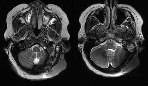 Cochlear Implants And Mri Safety