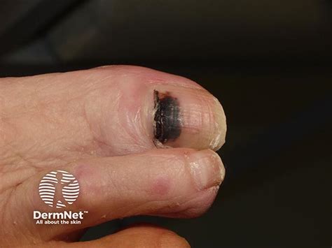 Acral Lentiginous Melanoma Pictures Causes Prognosis