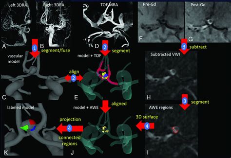 Regional Aneurysm Wall Enhancement Is Affected By Local Hemodynamics A